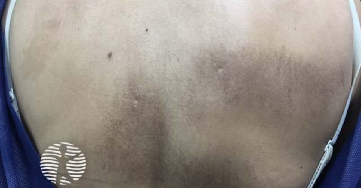 Macular amyloidosis image