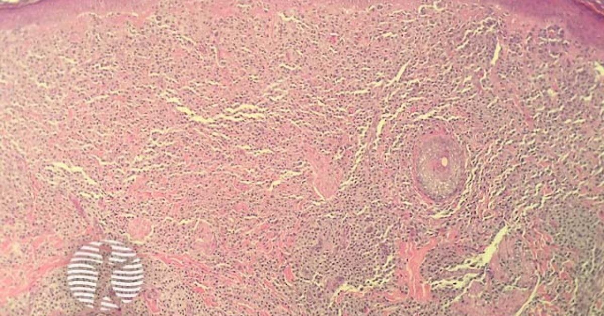 Maculopapular cutaneous mastocytosis image