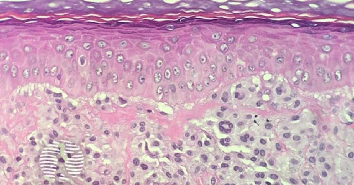 Maculopapular cutaneous mastocytosis image