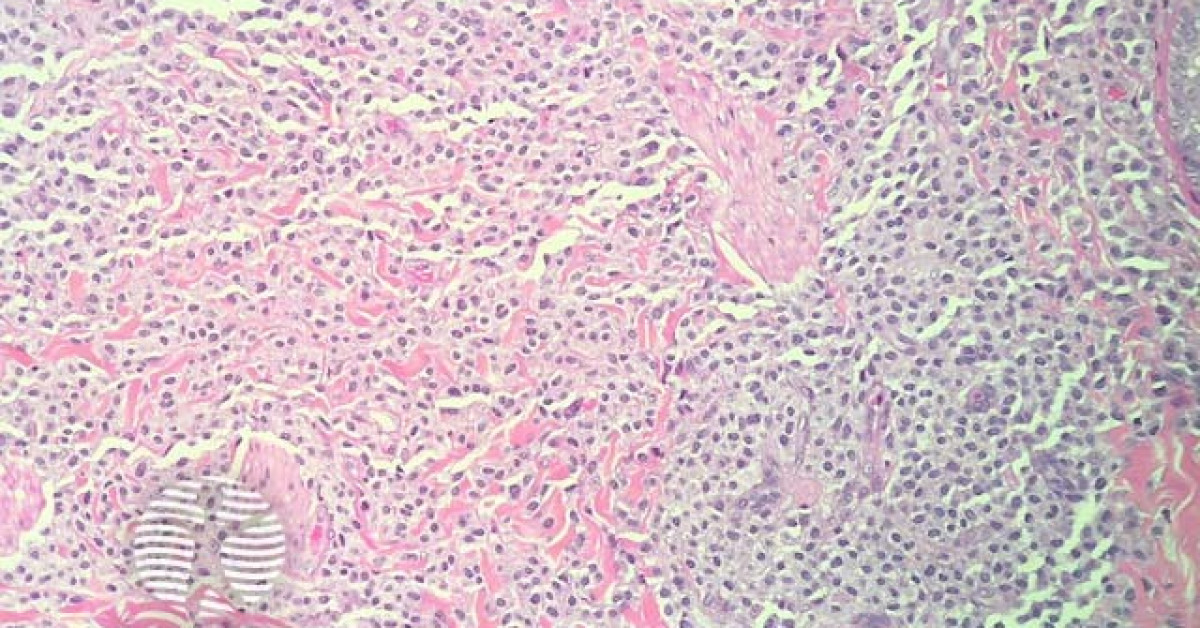 Maculopapular cutaneous mastocytosis image