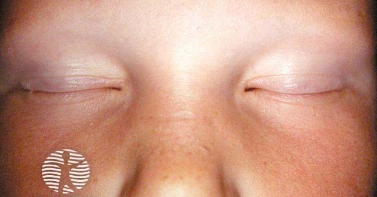 Madarosis due to alopecia areata image
