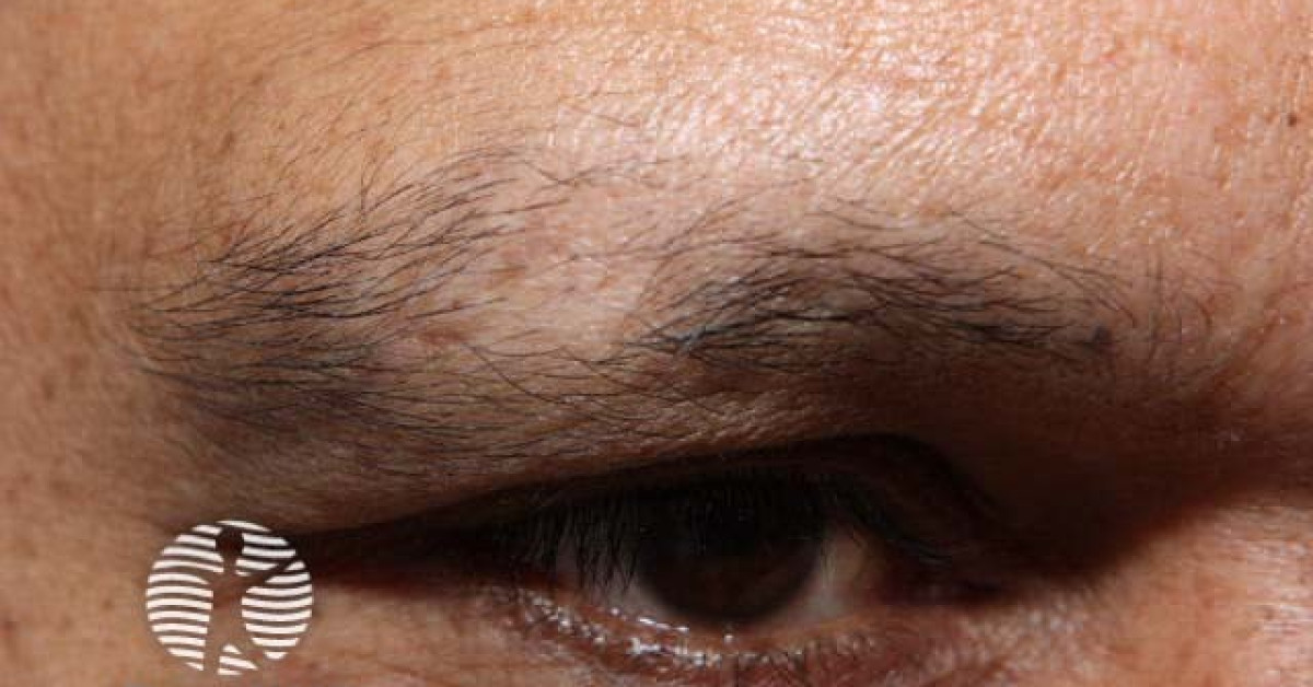 Madarosis due to alopecia areata image