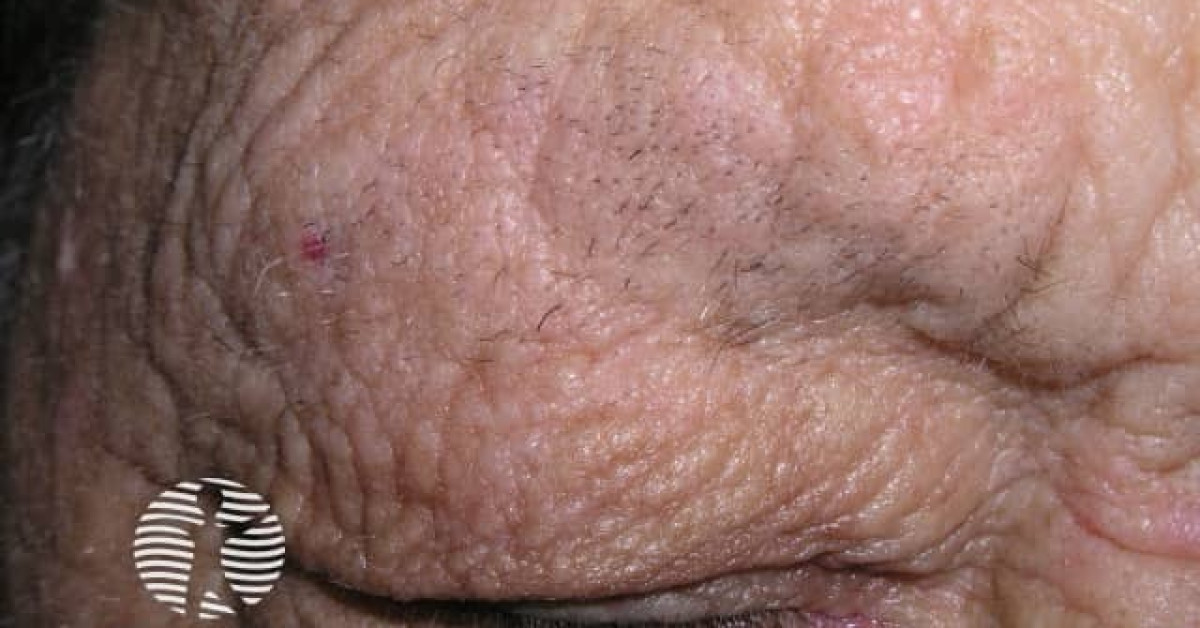 Madarosis due to atopic dermatitis image