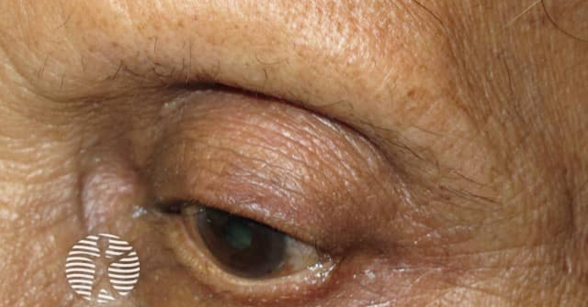 Madarosis in frontal fibrosing alopecia image