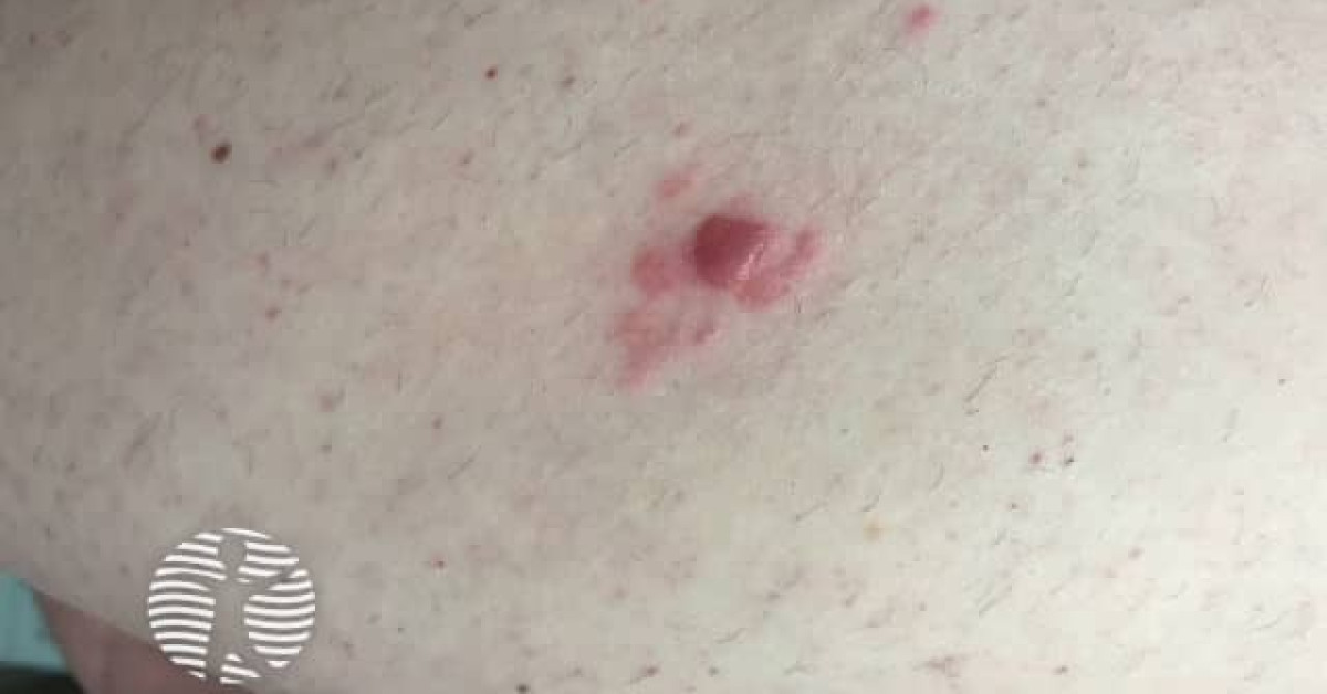 Marginal zone lymphoma image