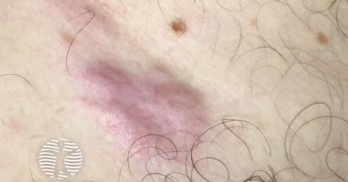 Cutaneous marginal zone lymphoma image