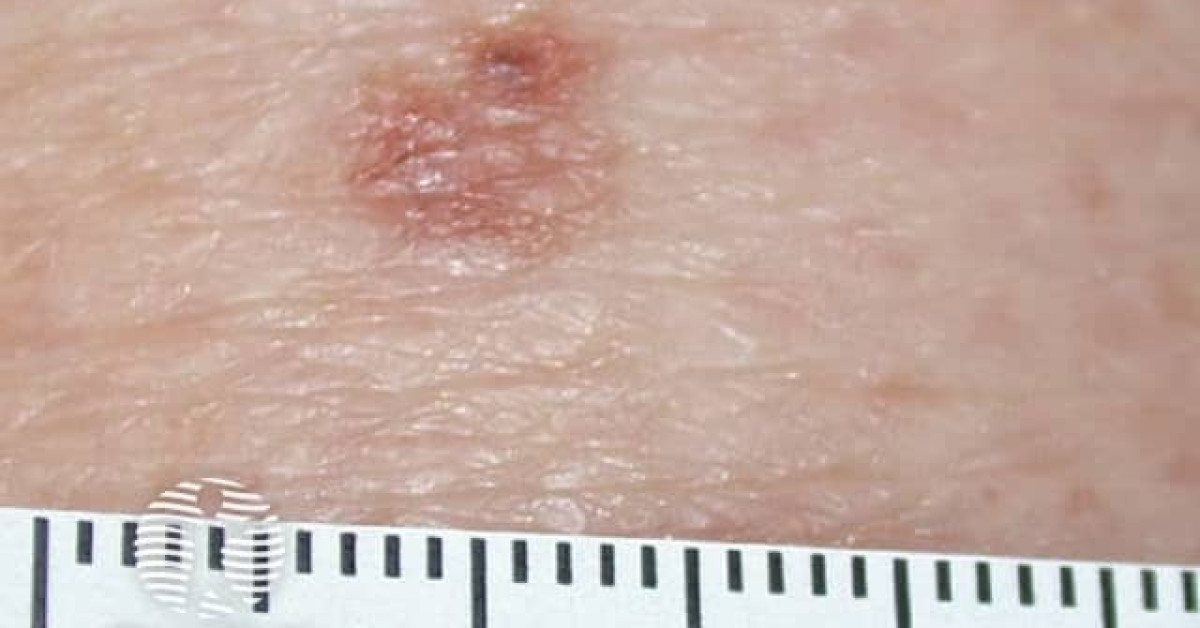 Melanoma in situ image