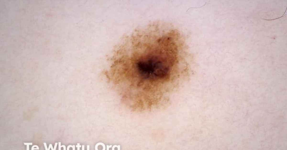 Atypical compound naevus, nonpolarised dermoscopy view image