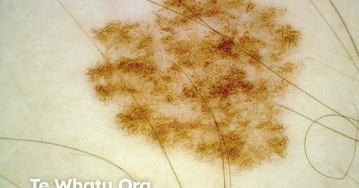 Melanocytic naevus, polarised dermoscopy view image