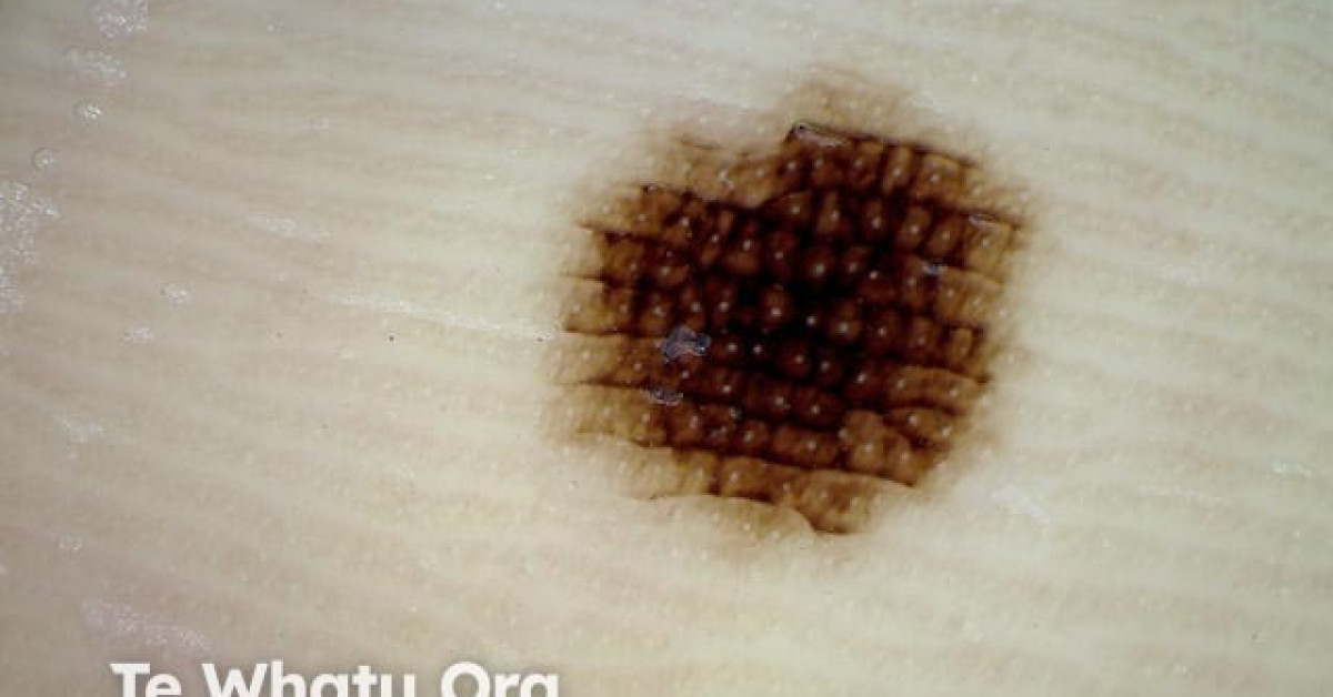 Acral naevus, nonpolarised dermoscopy view image