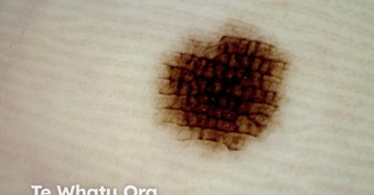 Acral naevus, polarised dermoscopy view image