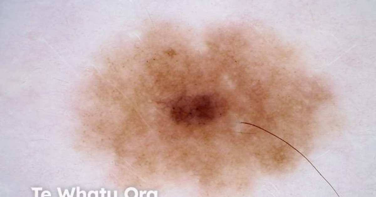 Melanocytic naevus, polarised dermoscopy view image