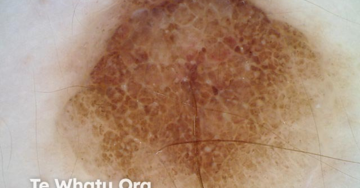 Melanocytic naevus, polarised dermoscopy view image