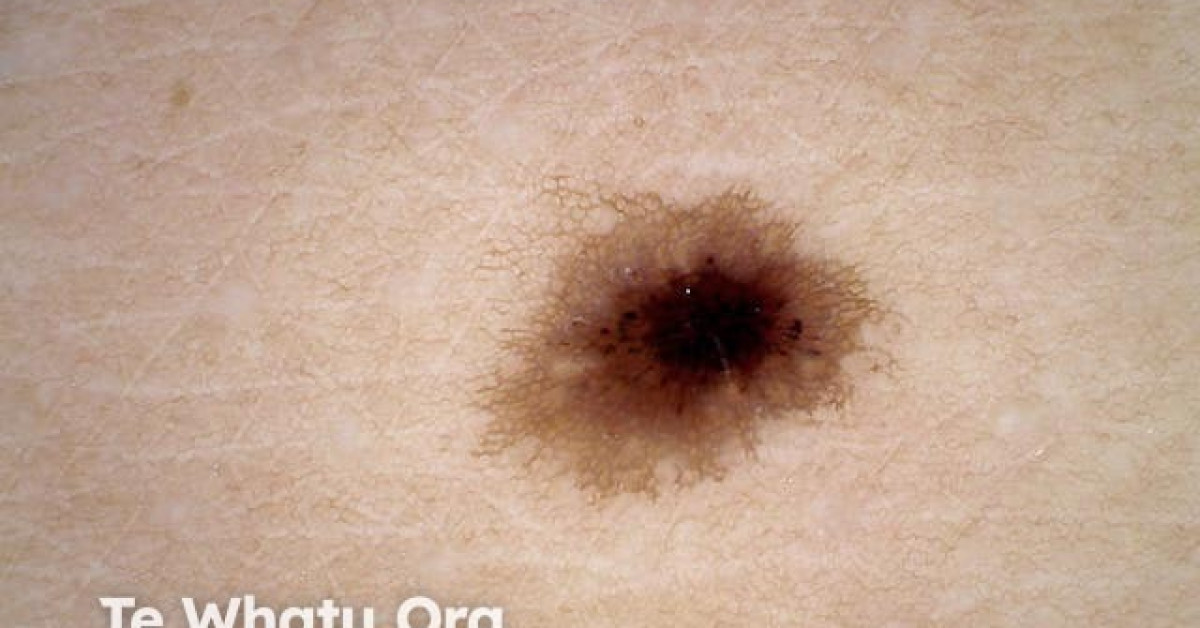 Melanocytic naevus, nonpolarised dermoscopy view image