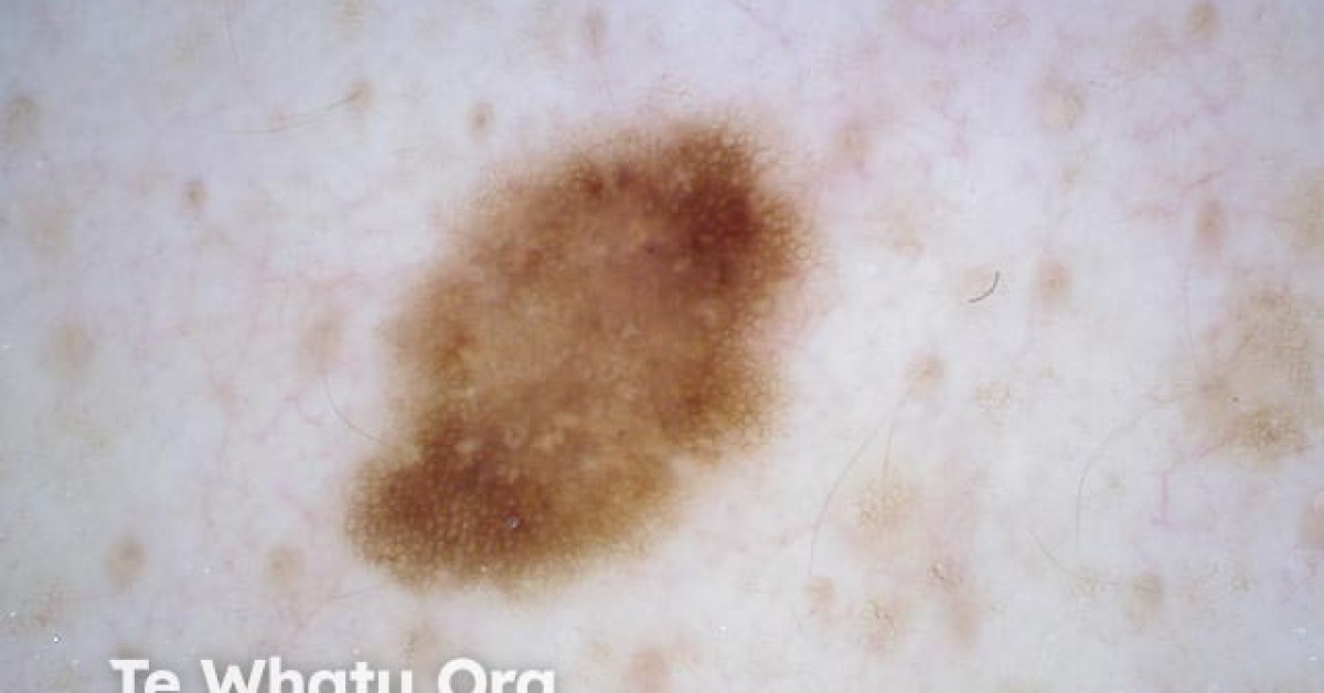 Melanocytic naevus, nonpolarised dermoscopy view image
