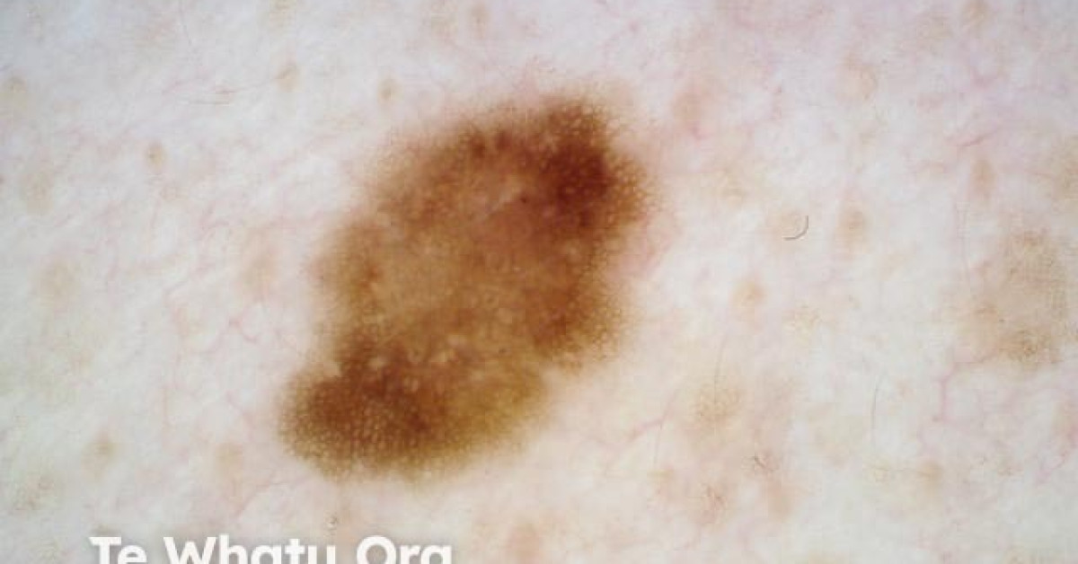 Melanocytic naevus polarised dermoscopy view image