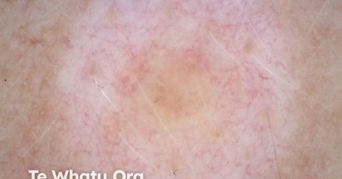 Halo naevus, polarised view image