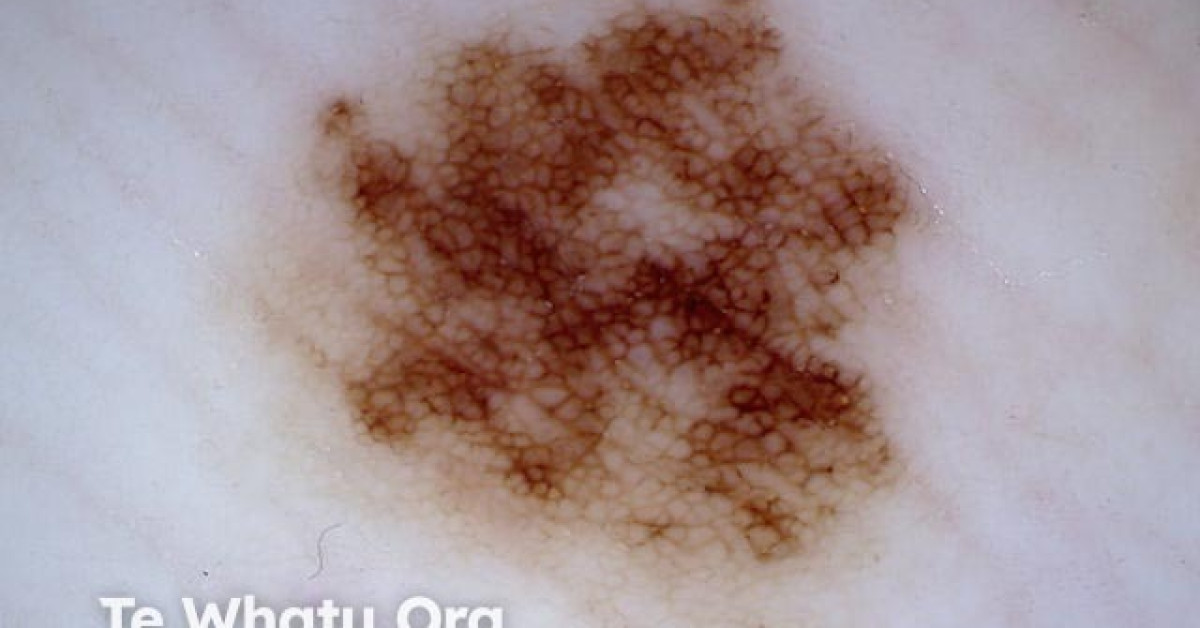 Melanocytic naevus, nonpolarised dermoscopy view image