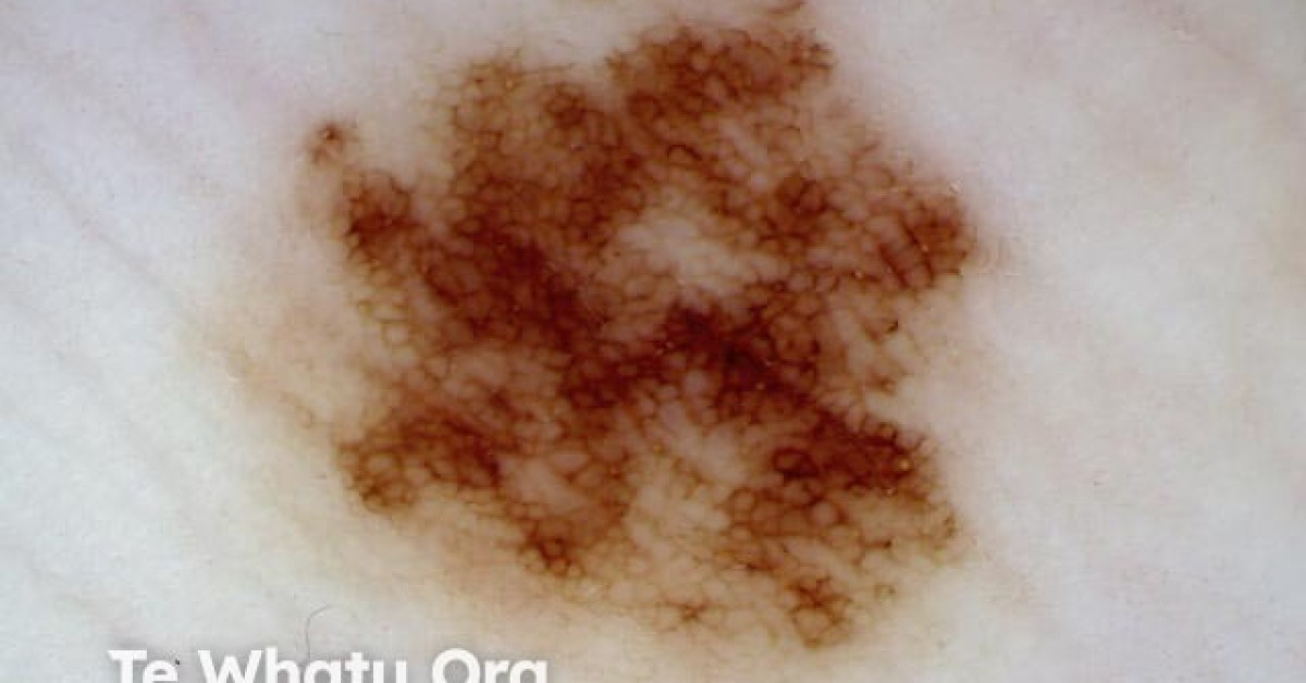 Melanocytic naevus, polarised dermoscopy view image