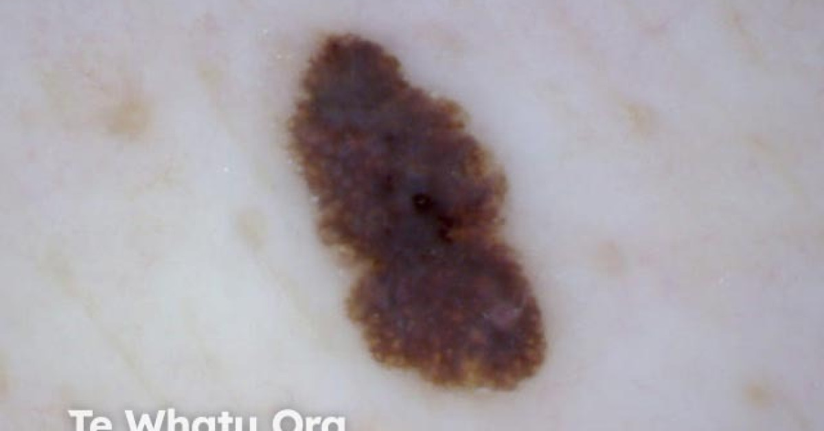 Melanocytic naevus, nonpolarised dermoscopy view image
