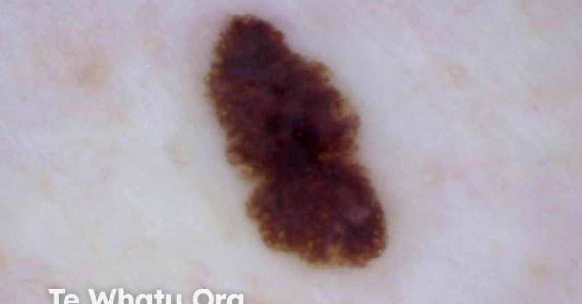 Melanocytic naevus, polarised dermoscopy view image