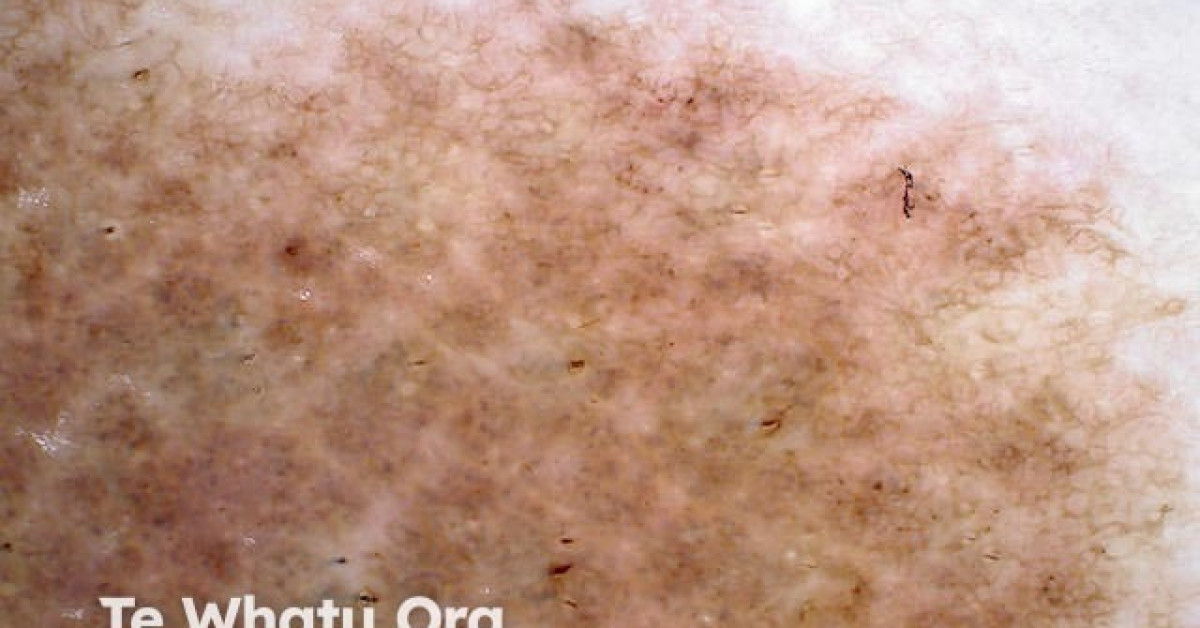 Congenital melanocytic naevus, nonpolarised dermoscopy view image