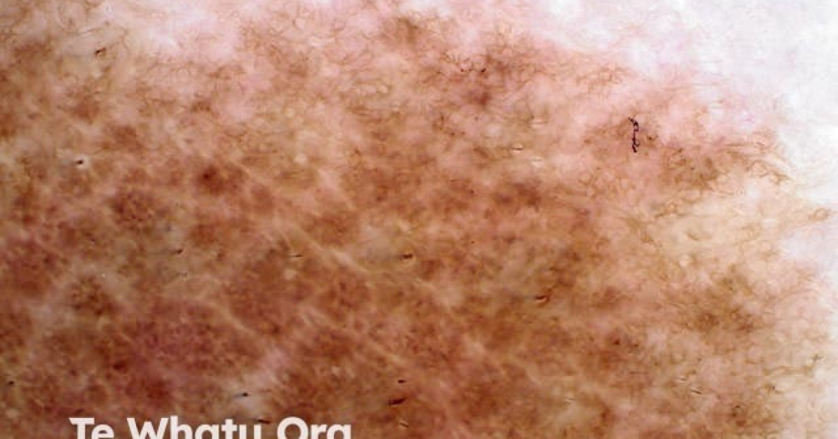 Congenital melanocytic naevus, polarised dermoscopy view image