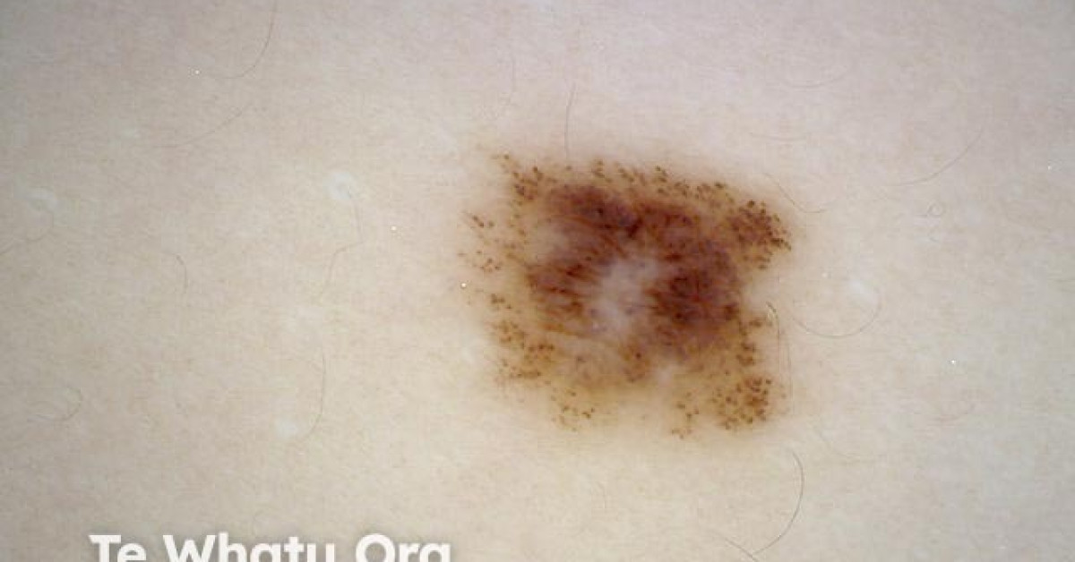 Congenital melanocytic naevus, nonpolarised dermoscopy view image