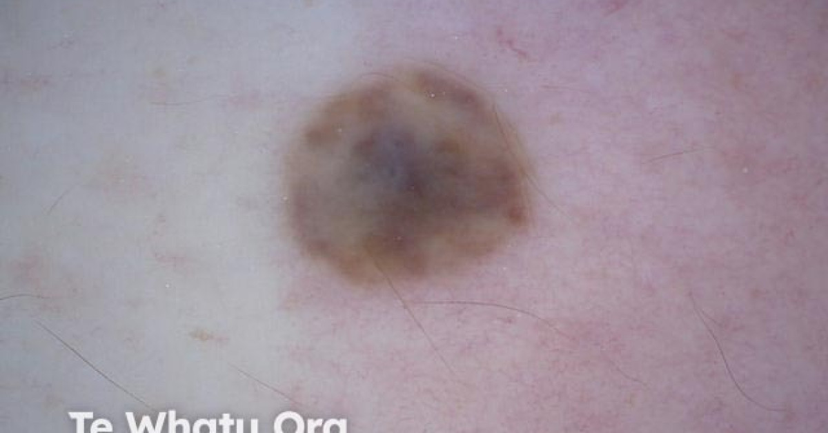 Blue naevus, nonpolarised dermoscopy view image