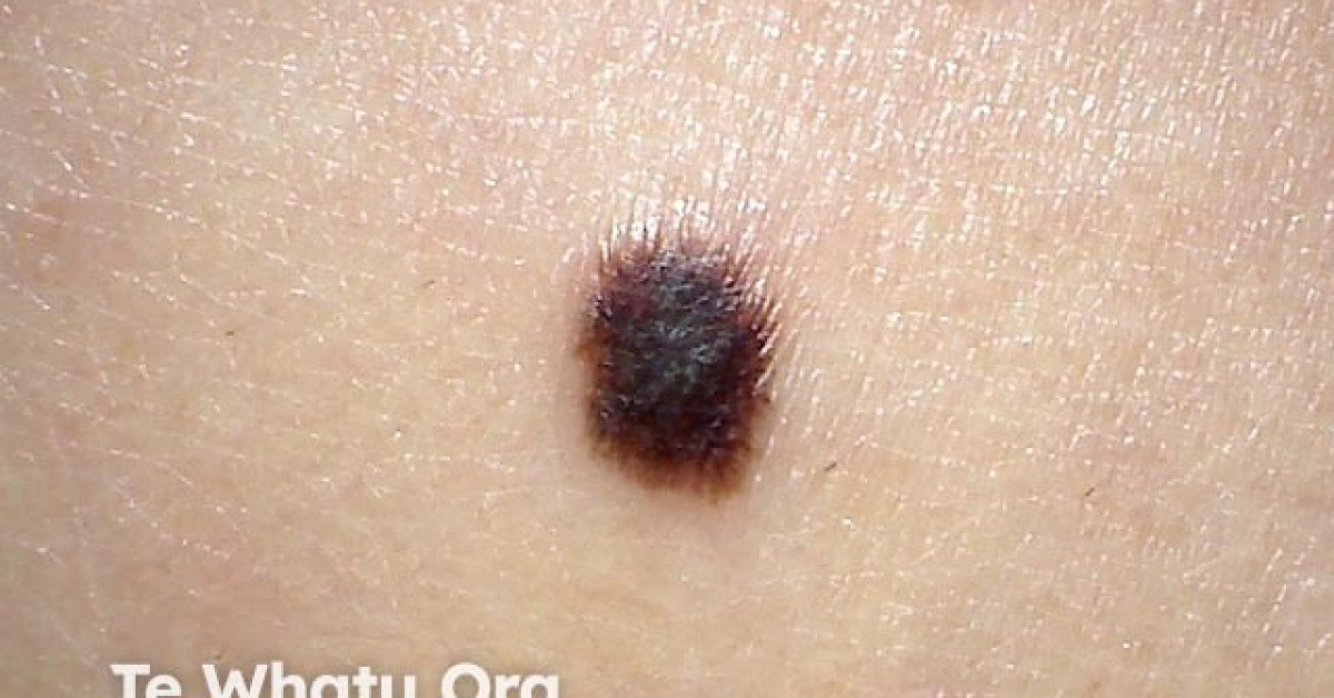 Reed naevus 2 macro image