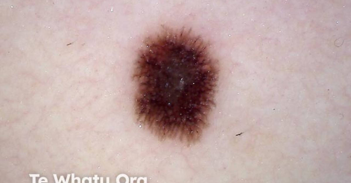 Reed naevus 2 dermoscopy image