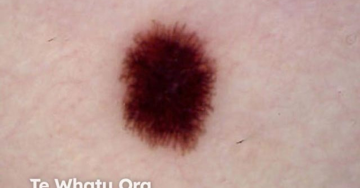 Reed naevus, polarised view image