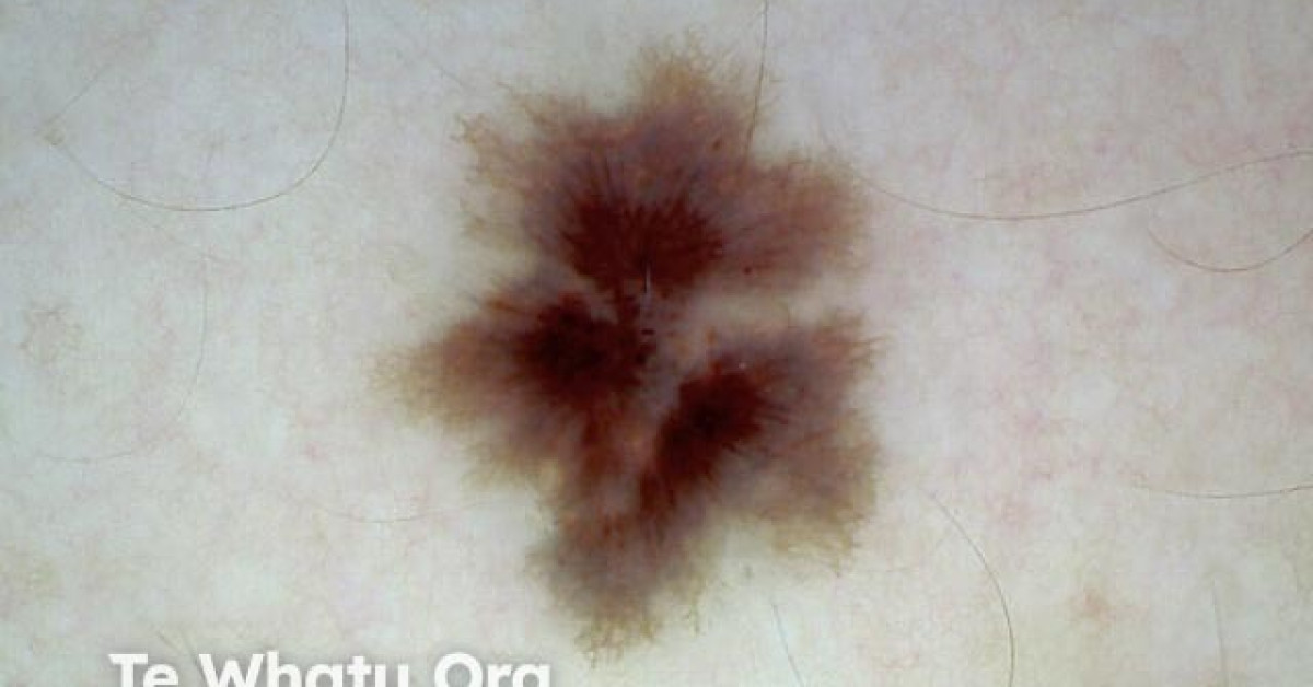 Lentiginous junctional naevus, nonpolarised dermoscopy view image