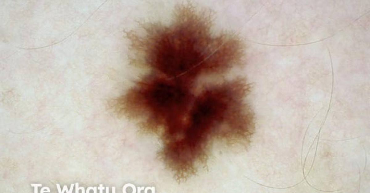 Lentiginous junctional naevus, polarised dermoscopy view image