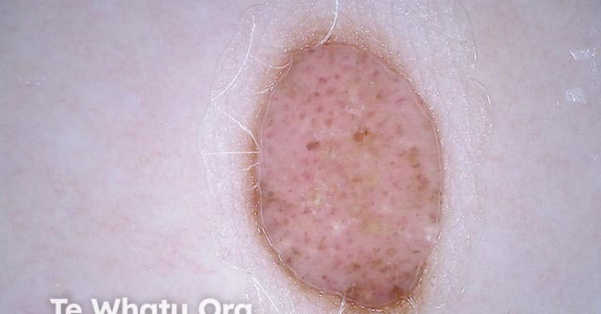 Dermal naevus, nonpolarised dermoscopy view image