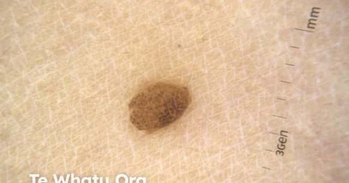 Melanocytic naevus image