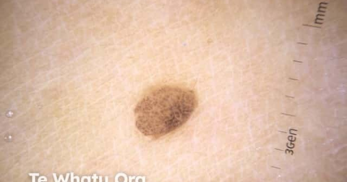 Melanocytic naevus image