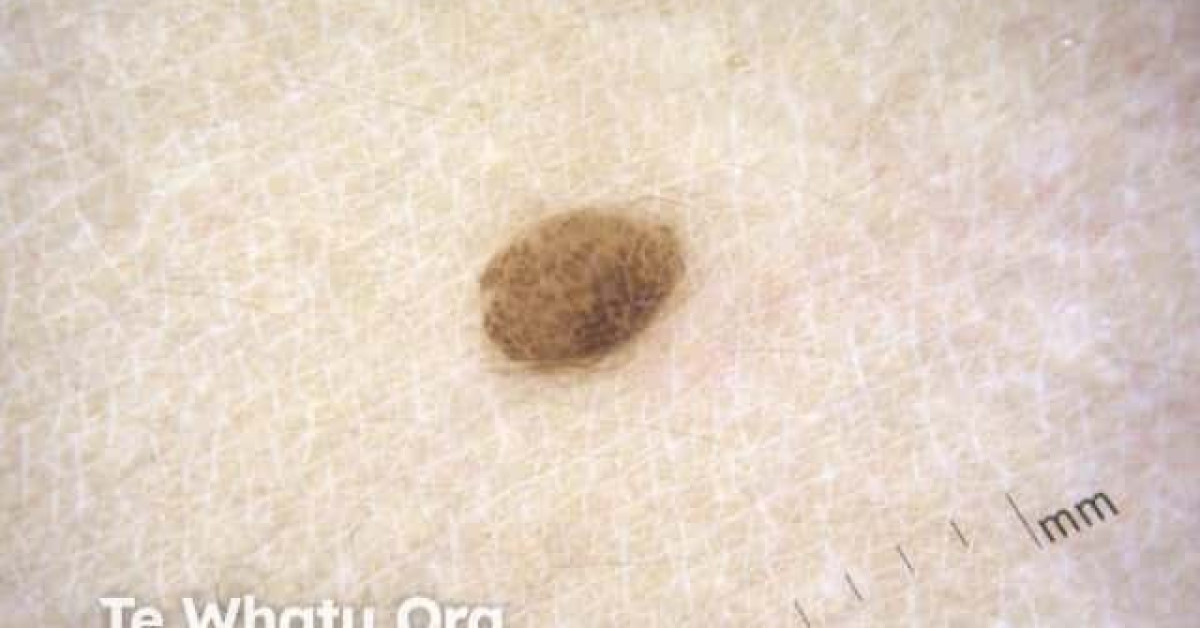 Melanocytic naevus image