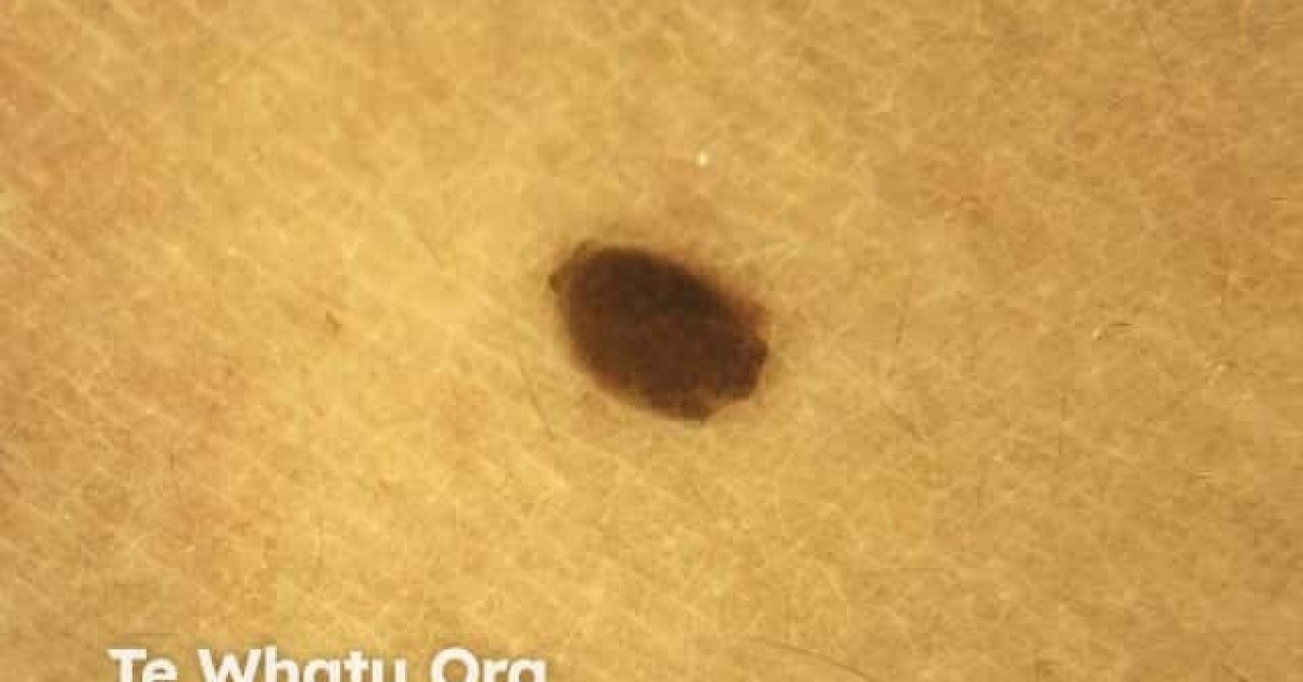 Melanocytic naevus image