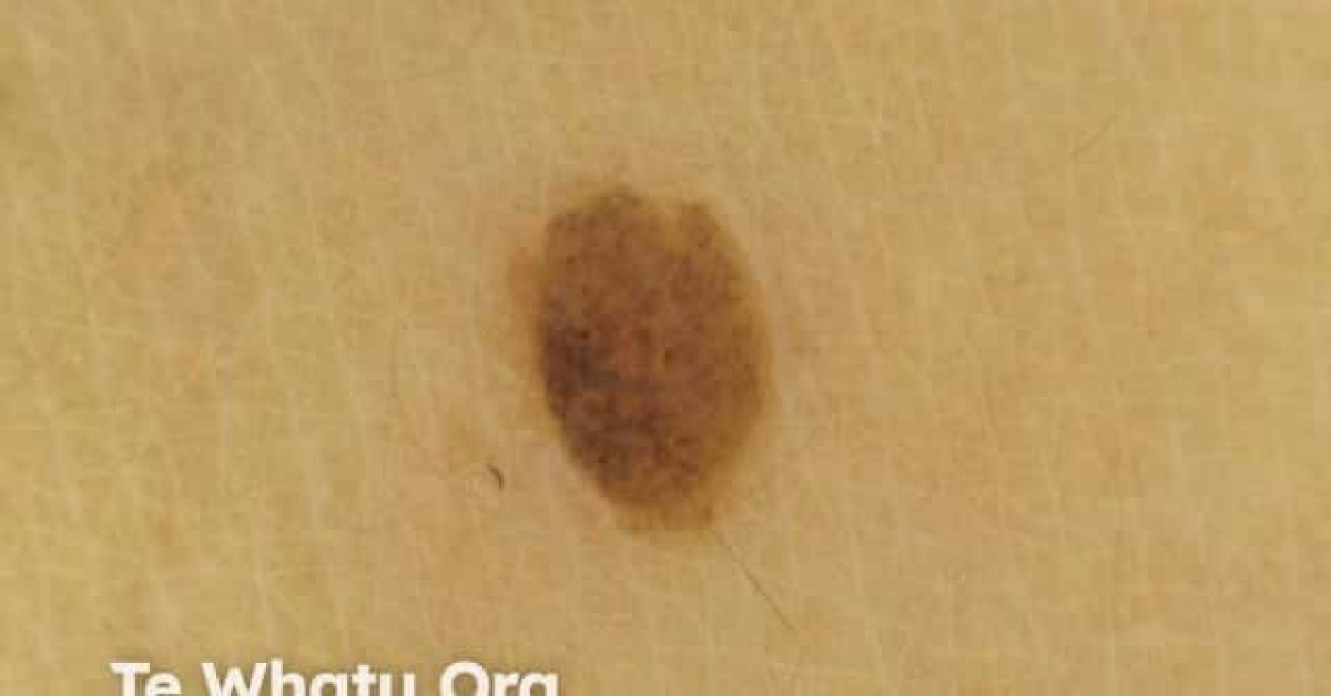 Melanocytic naevus image