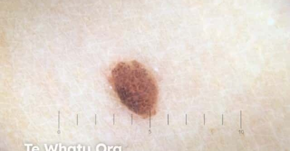 Melanocytic naevus image