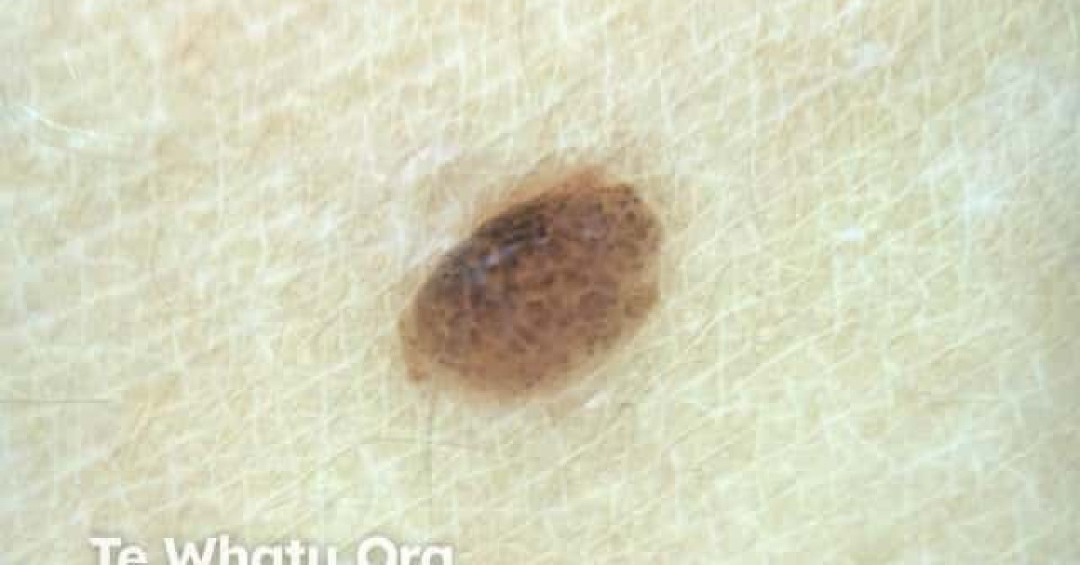 Melanocytic naevus image