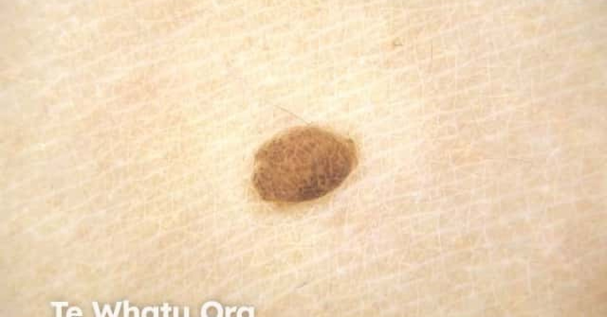 Melanocytic naevus image