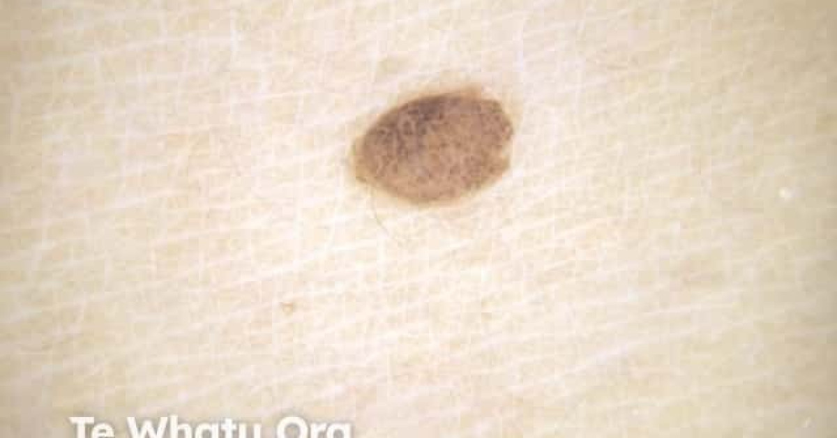 Melanocytic naevus image