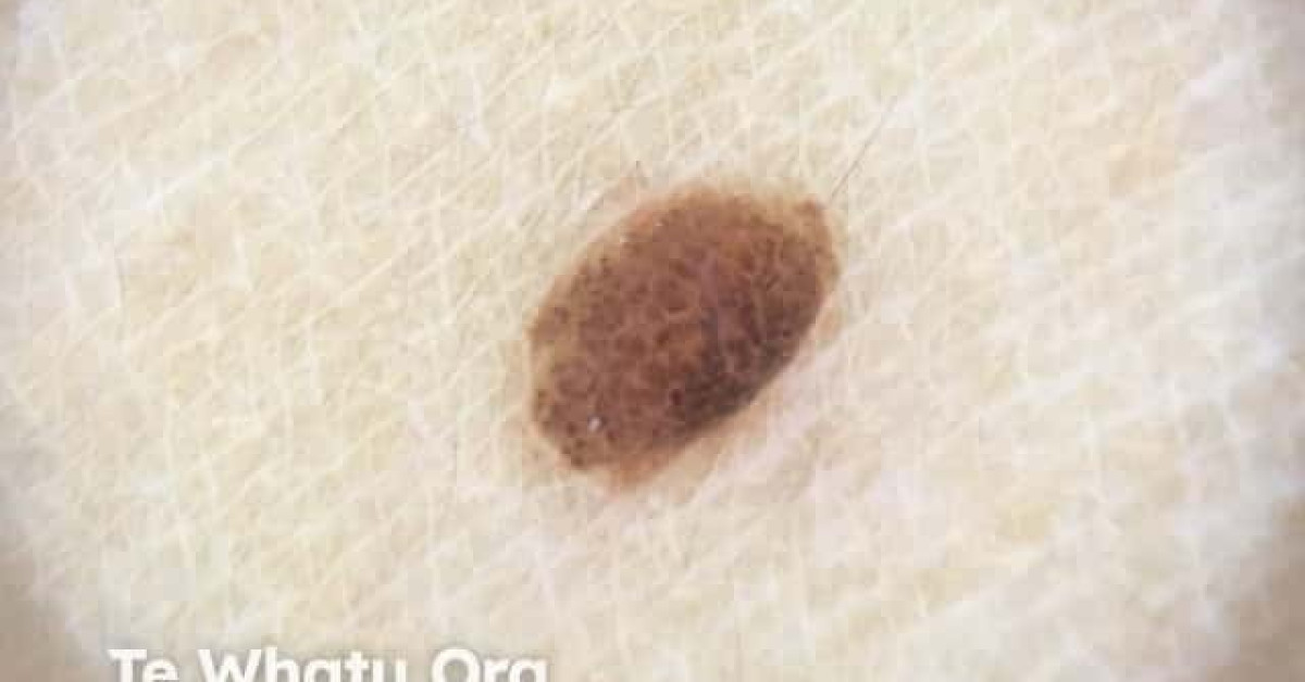 Melanocytic naevus image