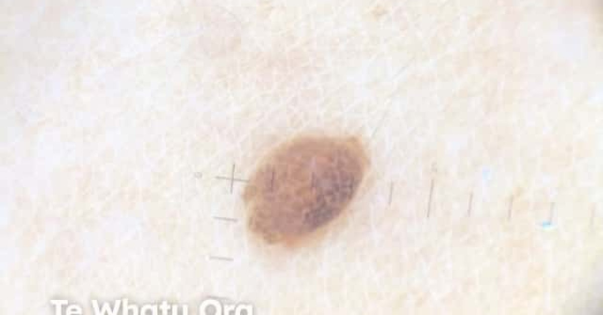 Melanocytic naevus image