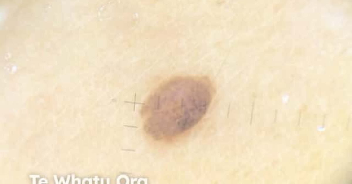 Melanocytic naevus image