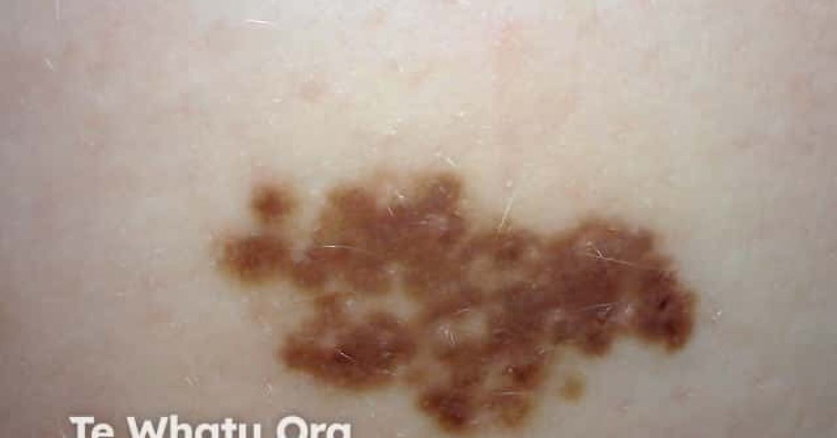 Congenital melanocytic naevus image