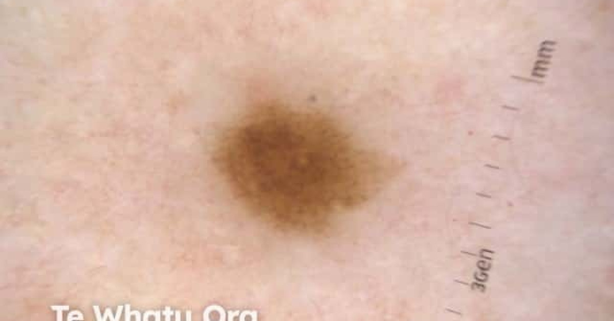 Melanocytic naevus image