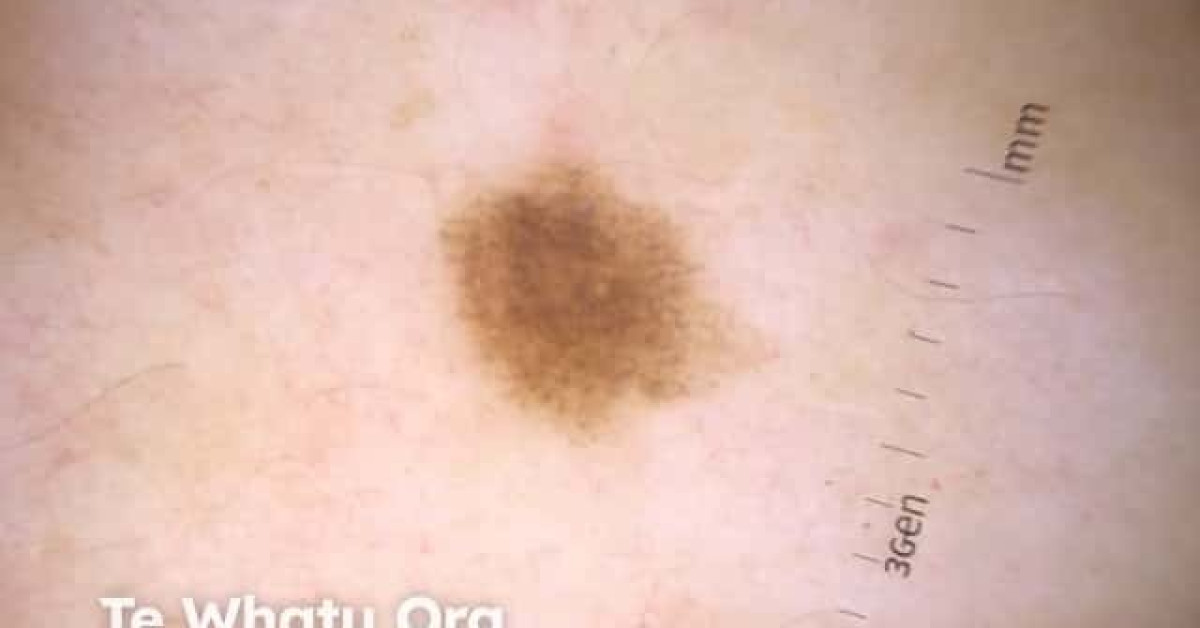 Melanocytic naevus image